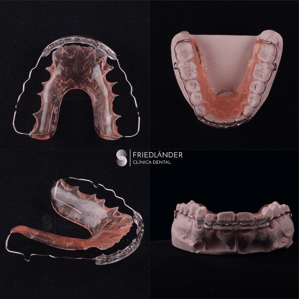 Retenedores fijos dentales | La retención fija en ortodoncia