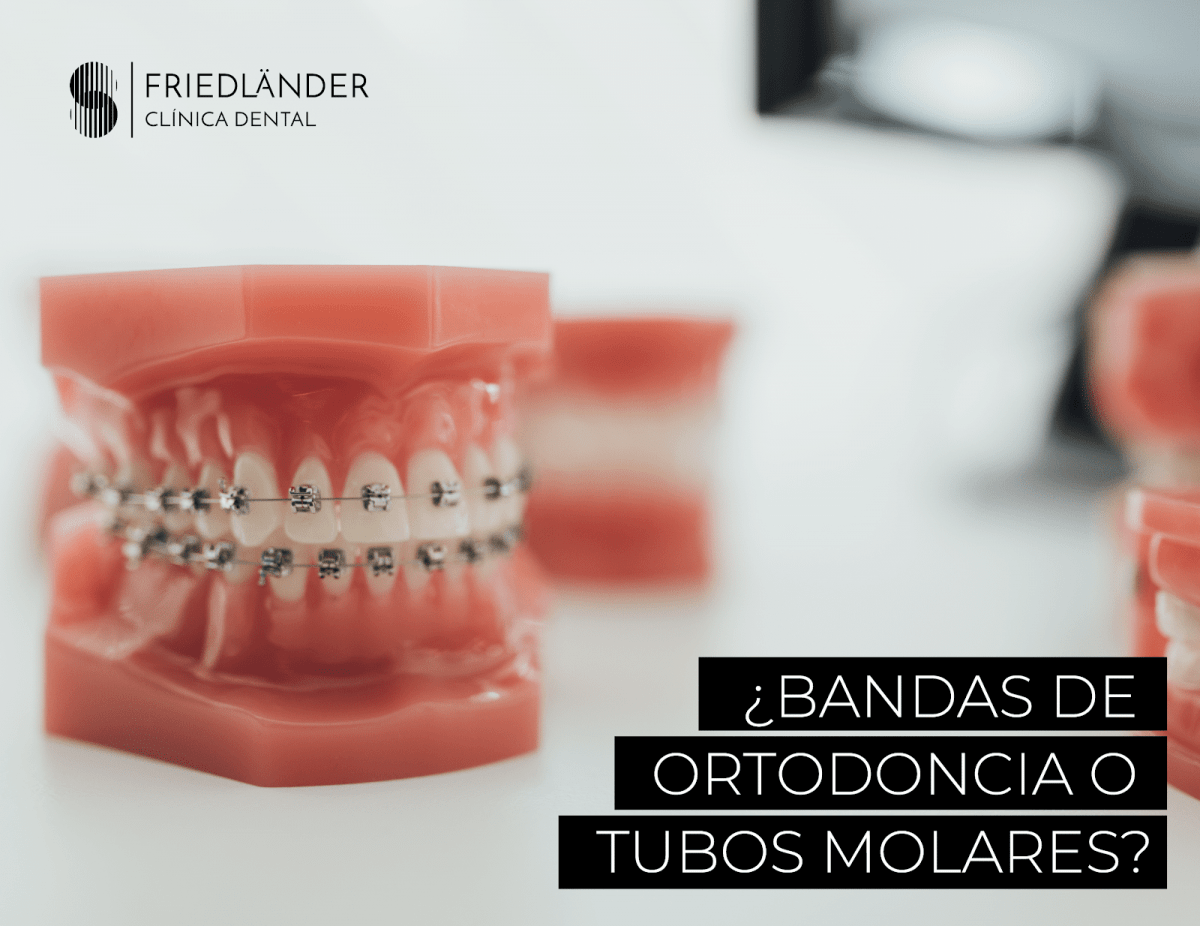 ¿Bandas de ortodoncia o tubos molares?| Brackets