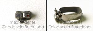 ¿Bandas de ortodoncia o tubos molares?| Brackets