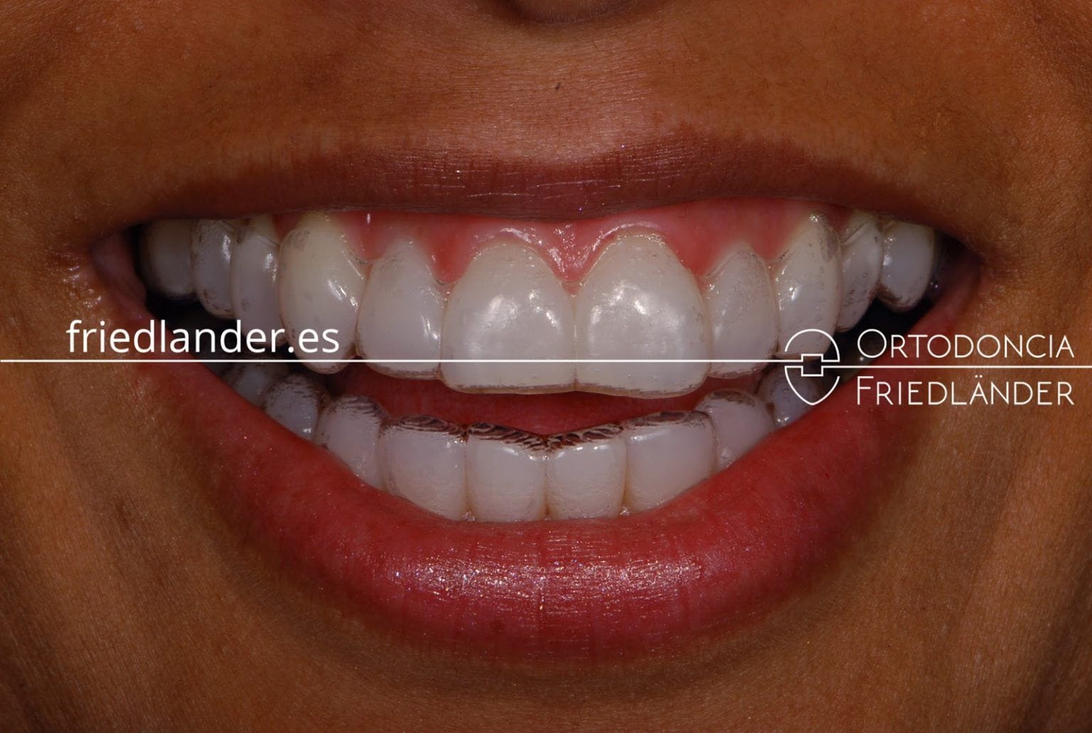 ¿Qué es la ortodoncia lingual? ¿Diferencias con Invisalign?