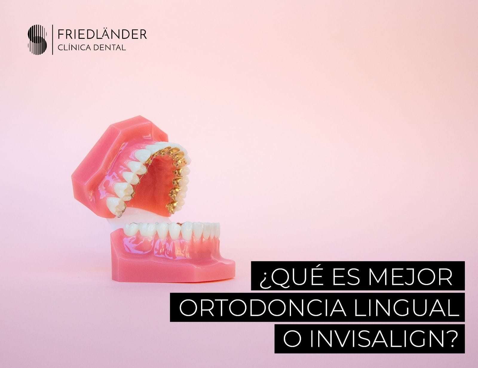 ¿Qué es mejor ortodoncia lingual o invisalign? | Blog de Ortodoncia