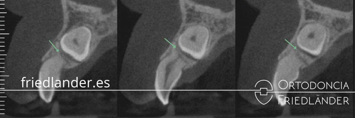Reabsorciones radiculares o acortamiento de las raíces: ¿Qué es?