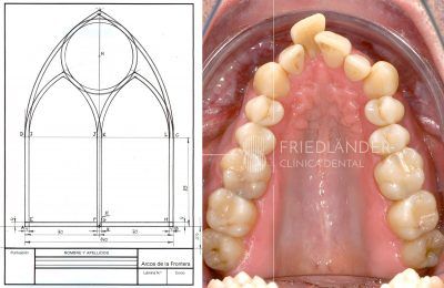 Paladar estrecho en adultos, causas y tratamientos