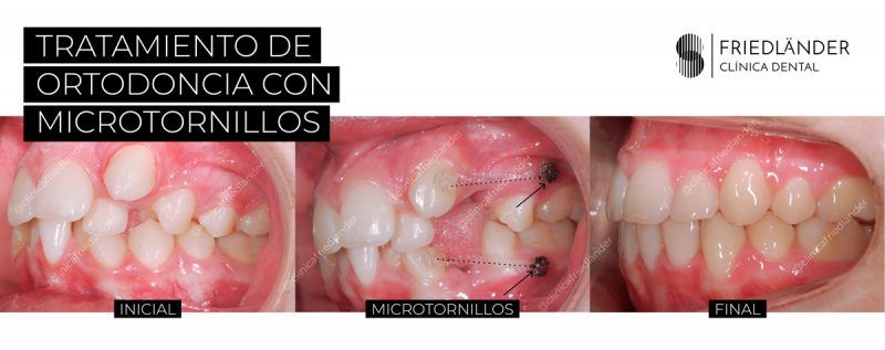 Microtornillos en ortodoncia: ¿Qué es? | Clínica Friedländer
