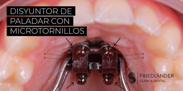 Microtornillos en ortodoncia: ¿Qué es? | Clínica Friedländer