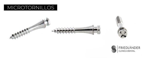 Microtornillos en ortodoncia: ¿Qué es? | Clínica Friedländer