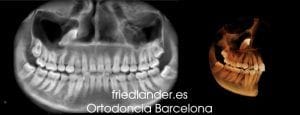 Caninos incluidos o canino cruzado: ¿qué es? | Friedländer