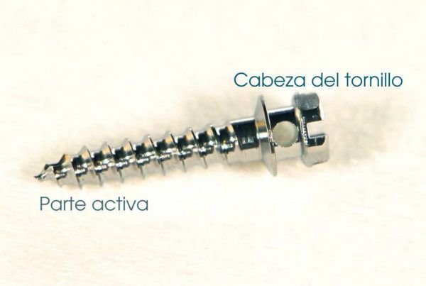 Los microtornillos en ortodoncia: ¿Qué son exactamente?