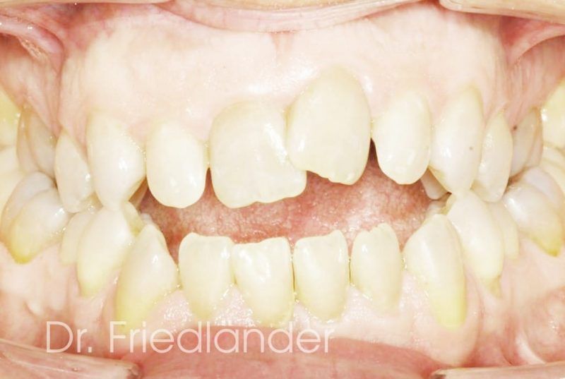 Tipos de maloclusión dental: Clase I, II y III