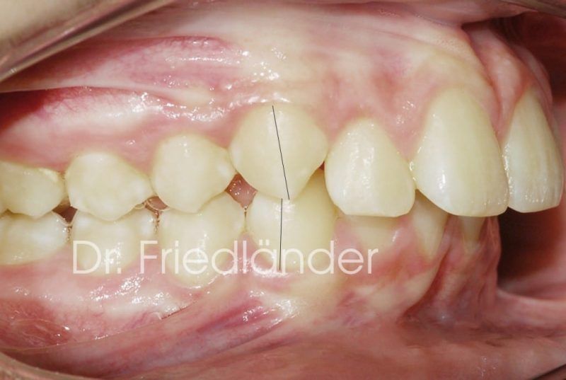 Tipos de maloclusión dental: Clase I, II y III