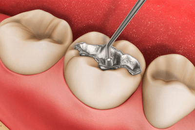 Cambio de amalgama, proceso | Clínica Dental Friedländer