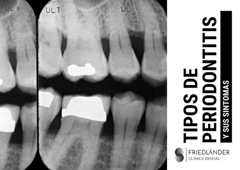 ¿Cuáles son los tipos de Periodontitis y cuáles son sus síntomas?