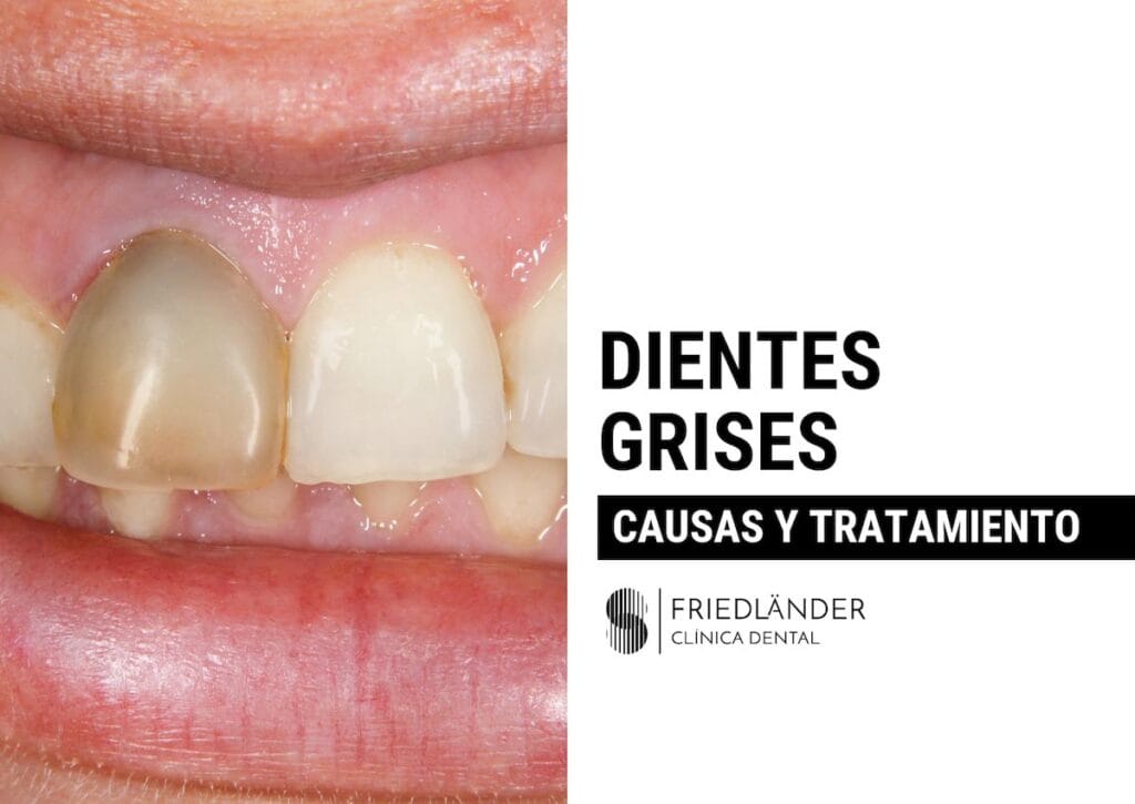 Dientes grises: Causas y tratamiento | Clínica Friedländer