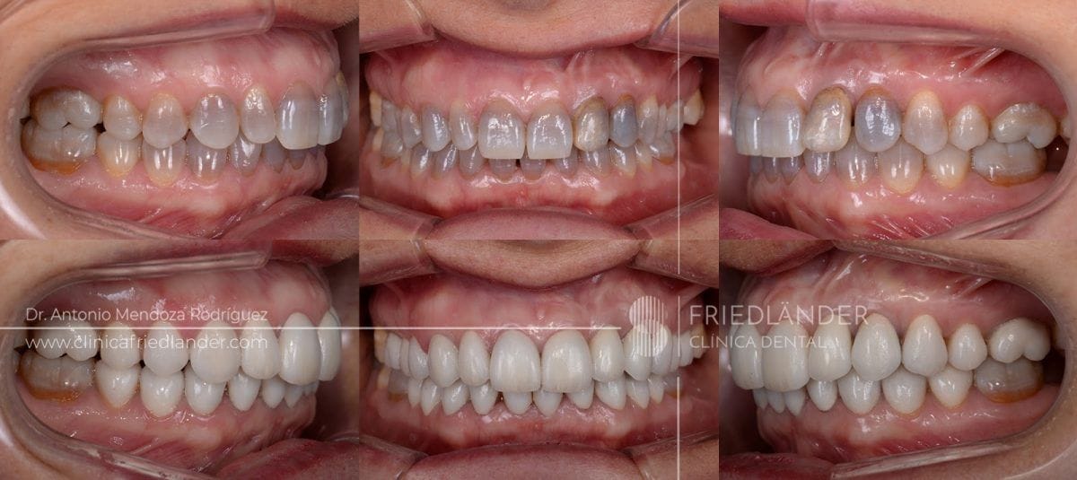 Dientes grises: Causas y tratamiento | Clínica Friedländer